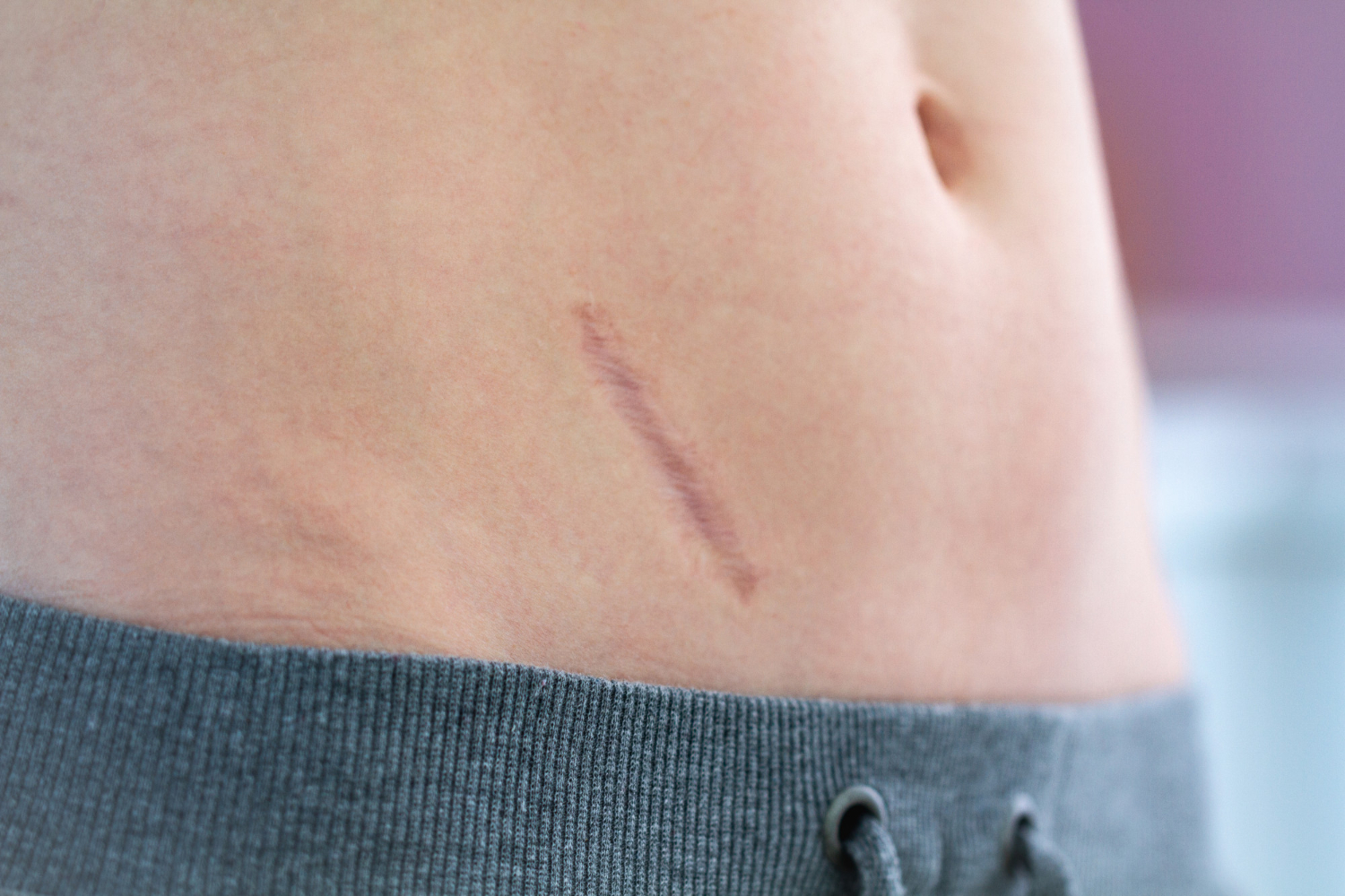 Scar Treatments Types, Procedures, And Results - Altaderma Clinic
