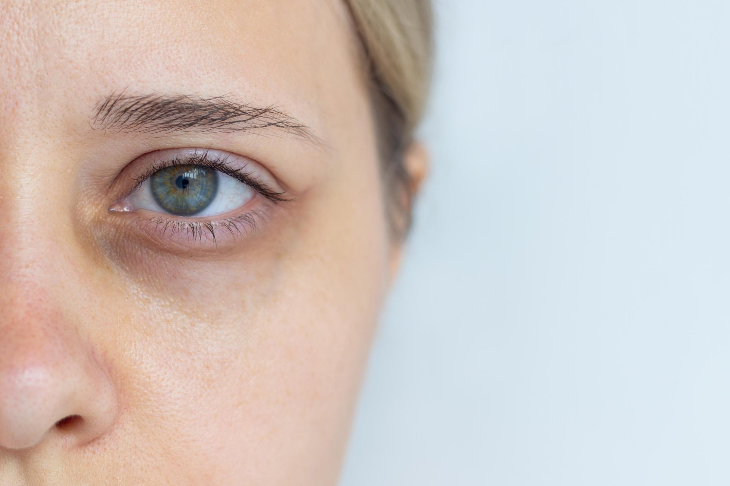 Best Dark Circle Treatments to Naturally Brighten and Refresh Your Eyes